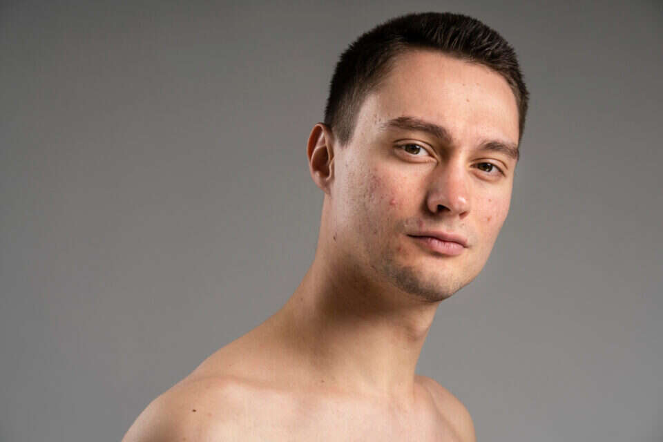 young-handsome-man-with-acne-960x640.jpg